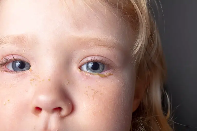 Gross Reason You Wake Up With Yellow Stuff In Your Eyes
